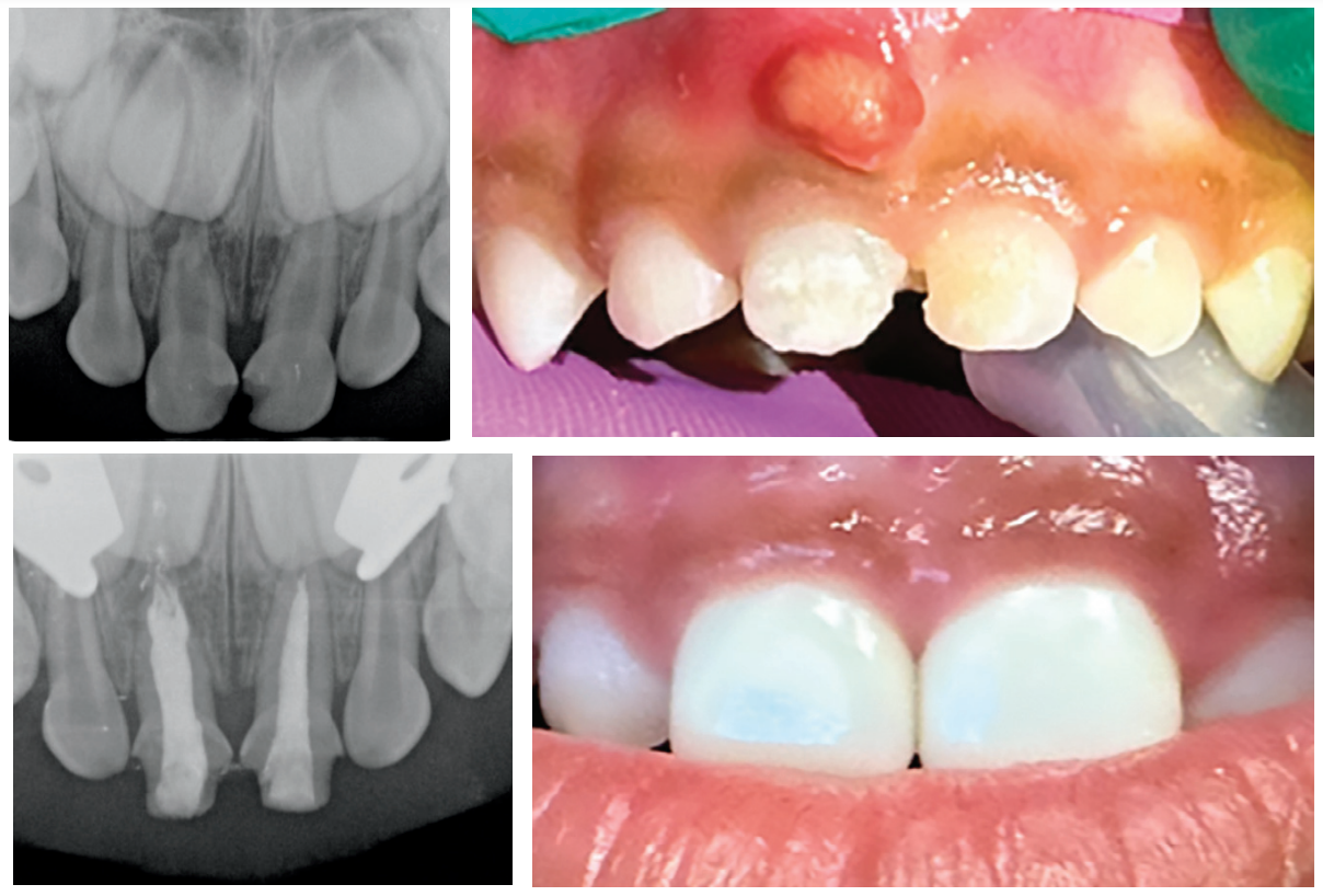 NuSmile® ZR Anterior Crowns — a highly esthetic treatment option