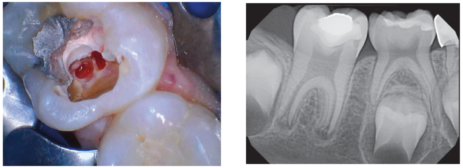 EndoSequence BC Pediatric Putty — creating better outcomes for young ...
