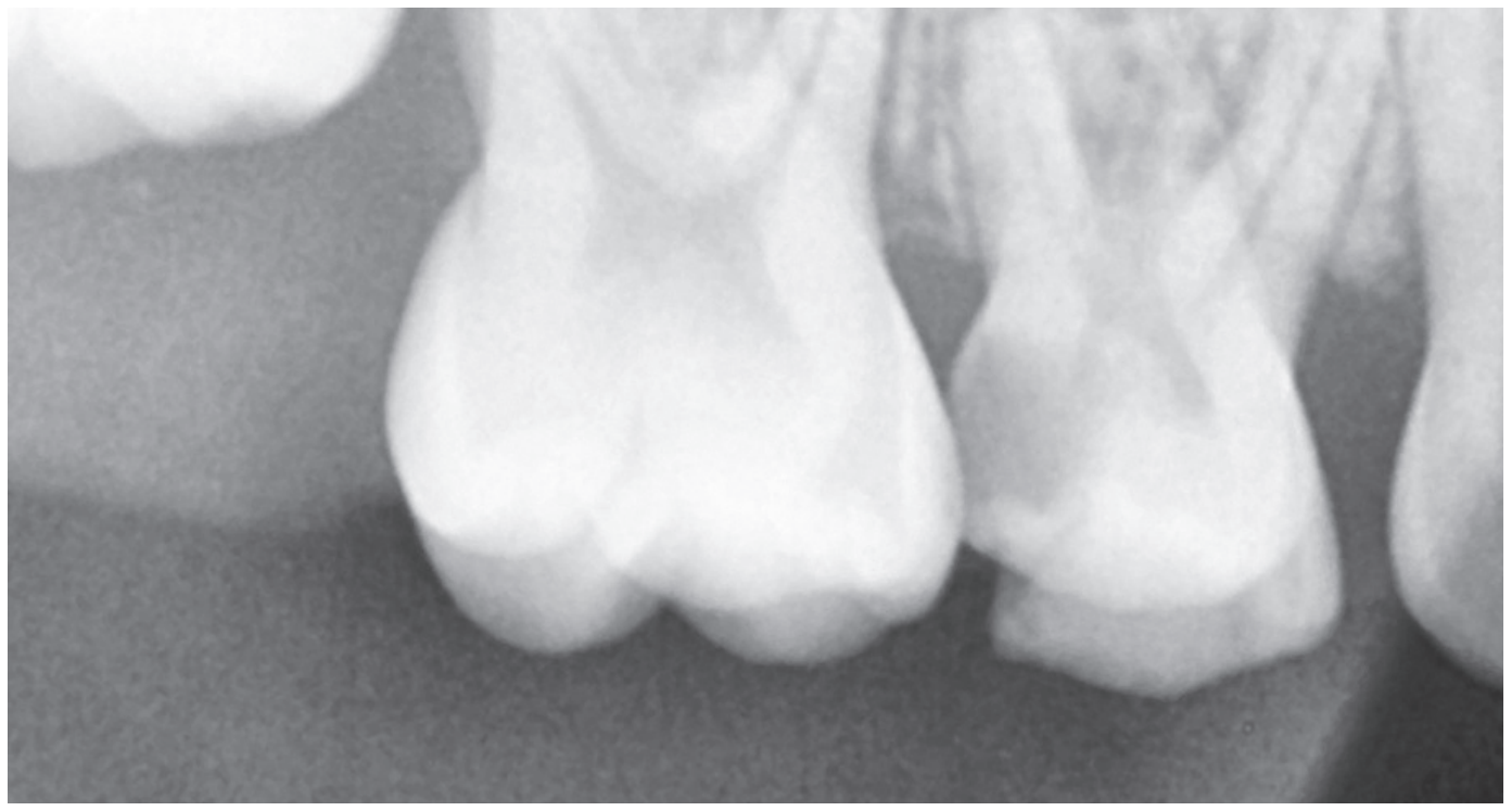 Universal Chairside Space Maintainers — developing the arch for ...